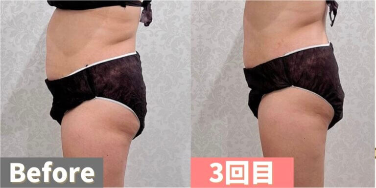 「今年こそ痩せたい!」そう思いながら5月を迎えたあなたへ。。。 茗荷谷 本郷三丁目 春日の人気美容室 Beautism【ビューティズム
